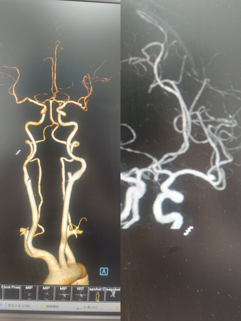 左侧大脑中动脉M2分叉部破裂动脉瘤支架辅助弹簧圈栓塞 - 脑医汇 - 神外资讯 - 神介资讯