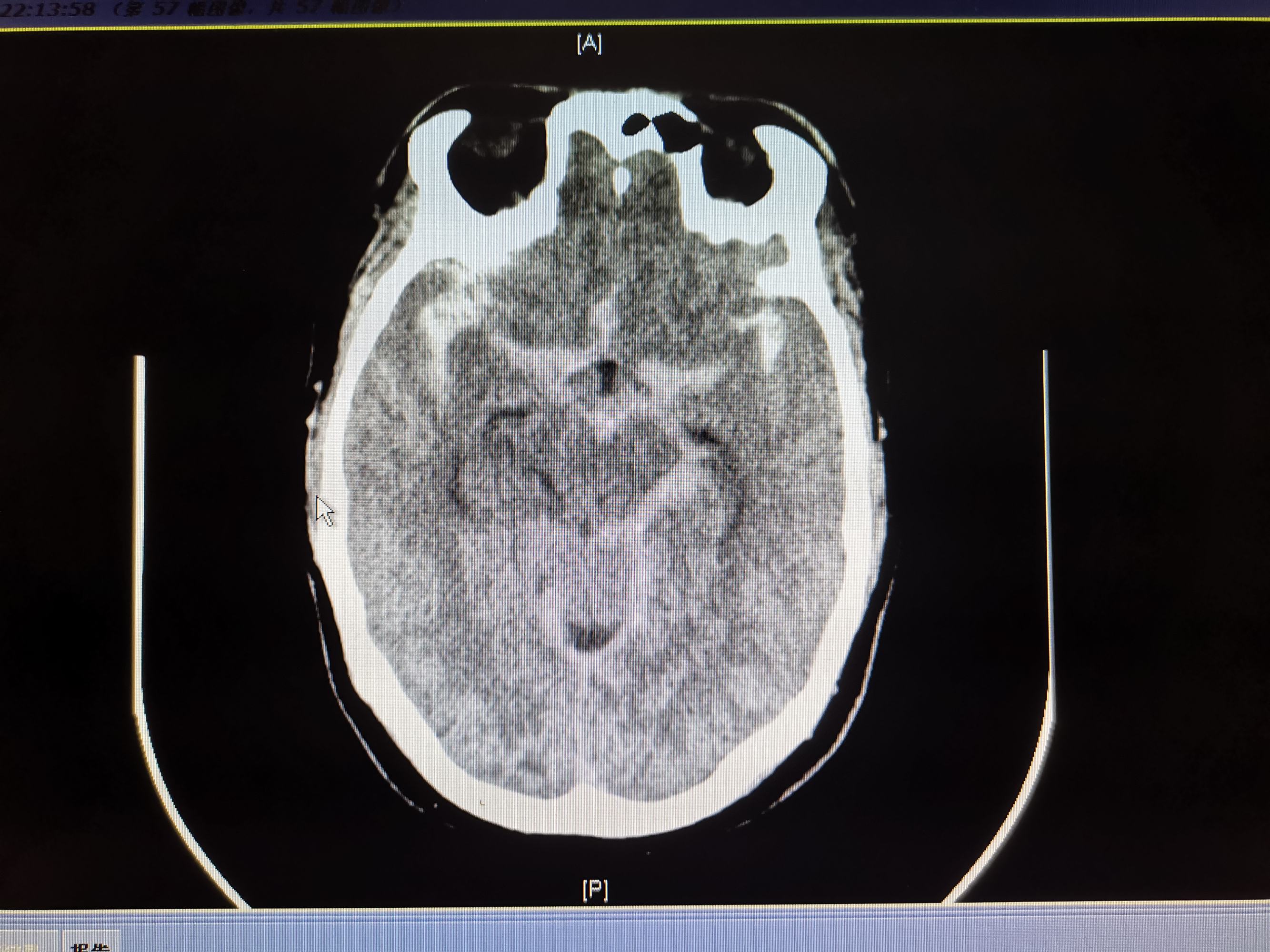 关于CTA阴性的M2段动脉瘤治疗 - 脑医汇