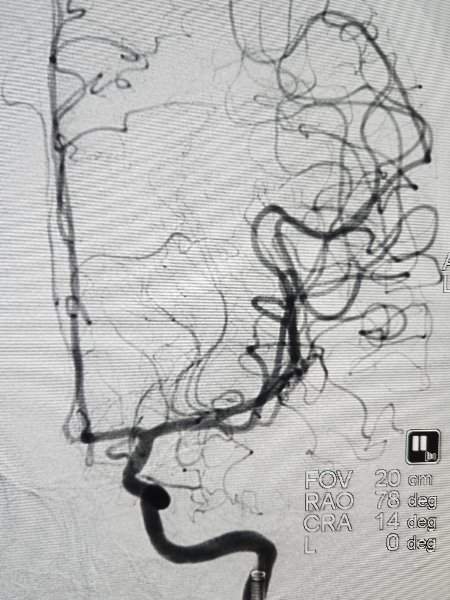卵圆孔未闭致大脑中动脉栓塞ADAPT取栓一例 - 脑医汇 - 神外资讯 - 神介资讯