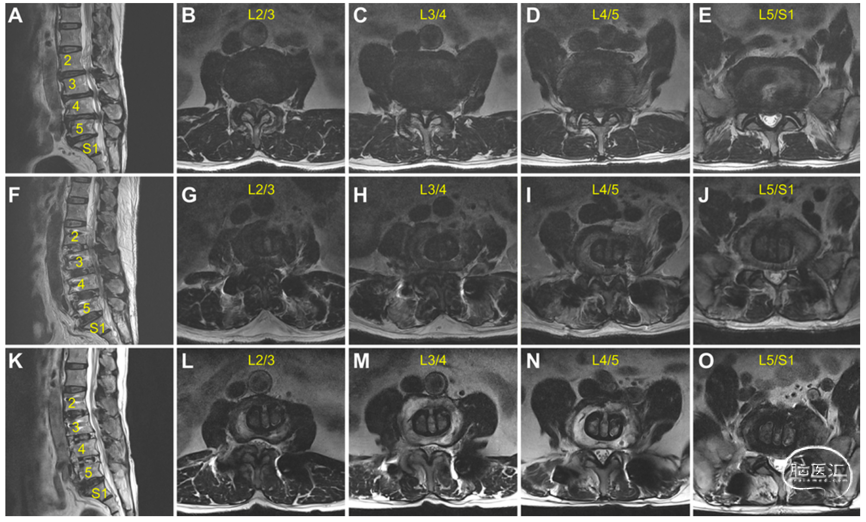 ALIF手术有没有间接减压效果？ - 脑医汇