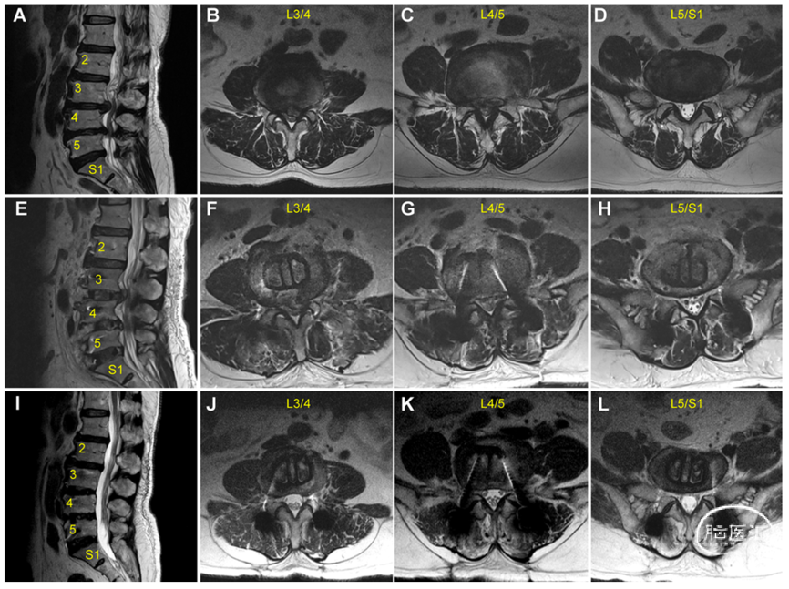 ALIF手术有没有间接减压效果？ - 脑医汇