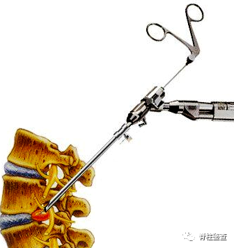 文献查阅丨PELD影像学测量 - 脑医汇