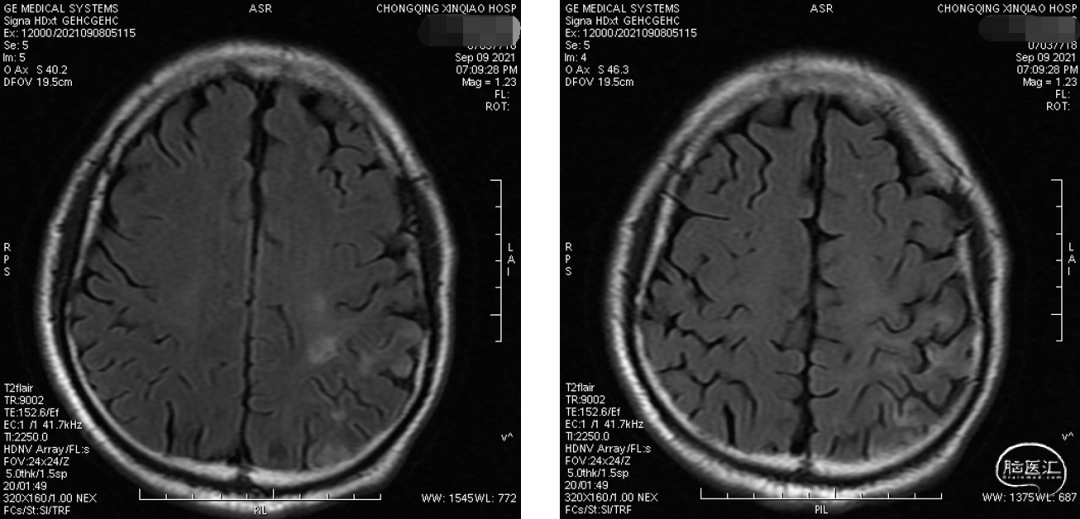 重磅！NOVA颅内载药支架重庆首例植入！ - 脑医汇 - 神外资讯 - 神介资讯
