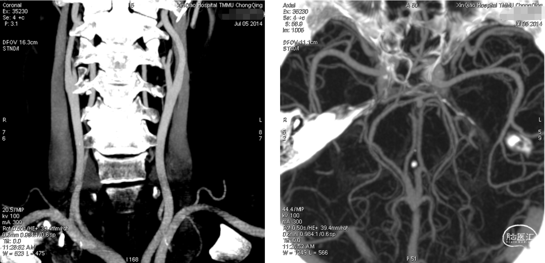 重磅！NOVA颅内载药支架重庆首例植入！ - 脑医汇 - 神外资讯 - 神介资讯