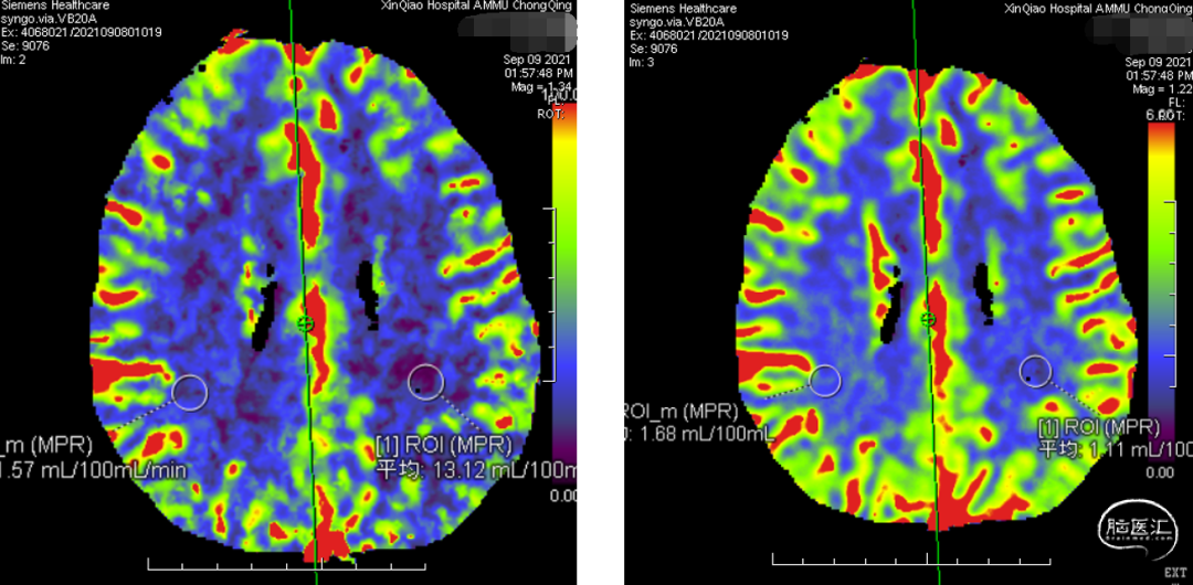 重磅！NOVA颅内载药支架重庆首例植入！ - 脑医汇 - 神外资讯 - 神介资讯