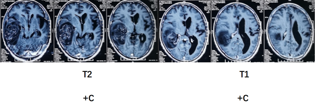 64岁男性，IDH突变型胶质母细胞瘤患者启动早期TTFields联合同步放化疗，病情持续稳定 - 脑医汇
