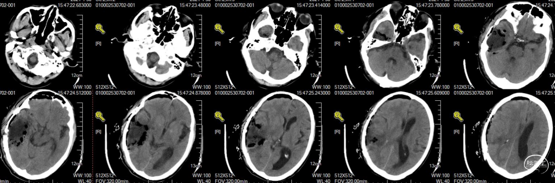 64岁男性，IDH突变型胶质母细胞瘤患者启动早期TTFields联合同步放化疗，病情持续稳定 - 脑医汇