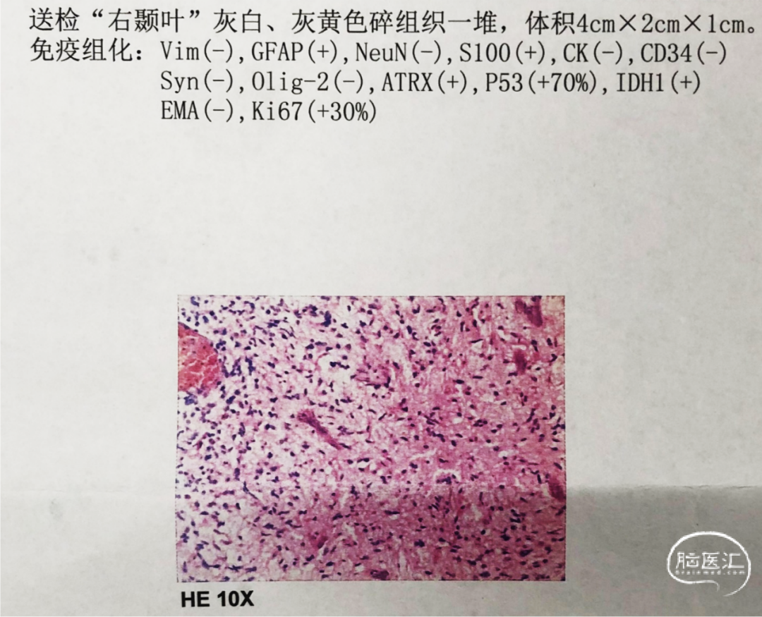 64岁男性，IDH突变型胶质母细胞瘤患者启动早期TTFields联合同步放化疗，病情持续稳定 - 脑医汇