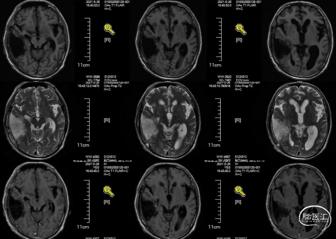 64岁男性，IDH突变型胶质母细胞瘤患者启动早期TTFields联合同步放化疗，病情持续稳定 - 脑医汇