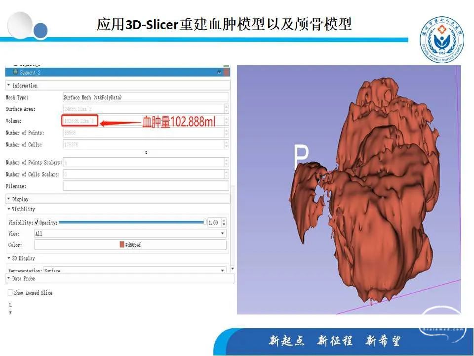 监测有道丨高血压脑出血去骨瓣减压清除血肿术后颅内感染治疗一例——颅脑创伤 神经重症周刊(第248期) 脑医汇