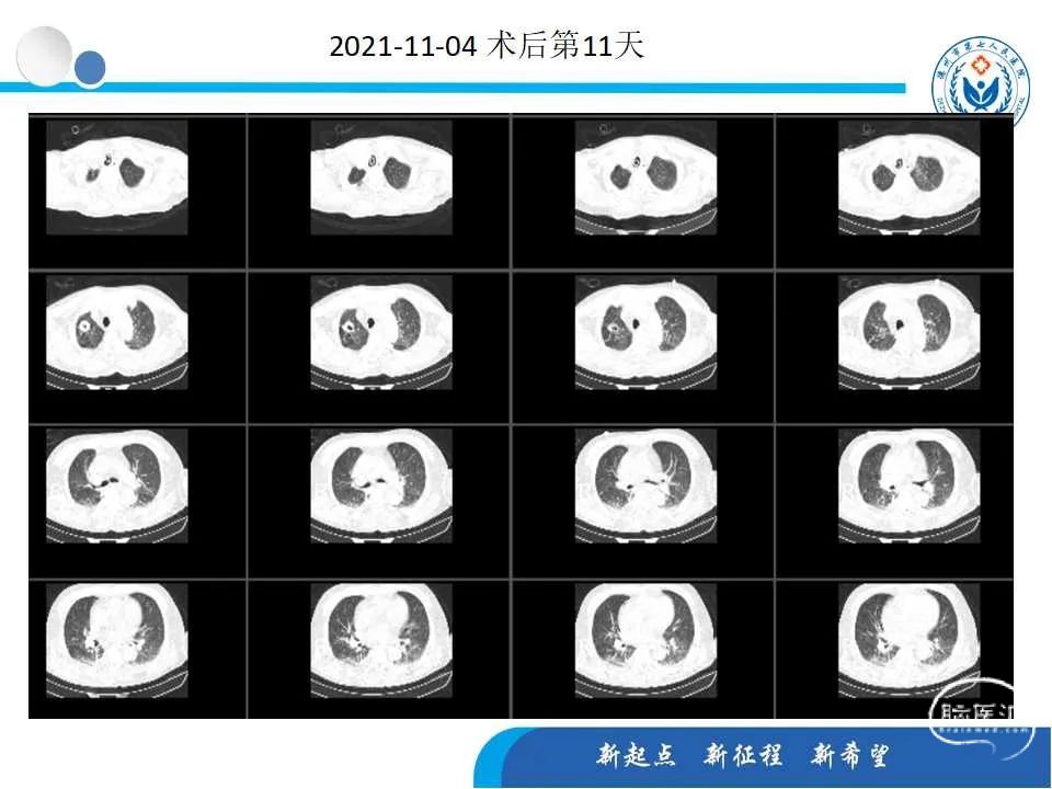 监测有道丨高血压脑出血去骨瓣减压清除血肿术后颅内感染治疗一例——颅脑创伤 神经重症周刊（第248期） 脑医汇