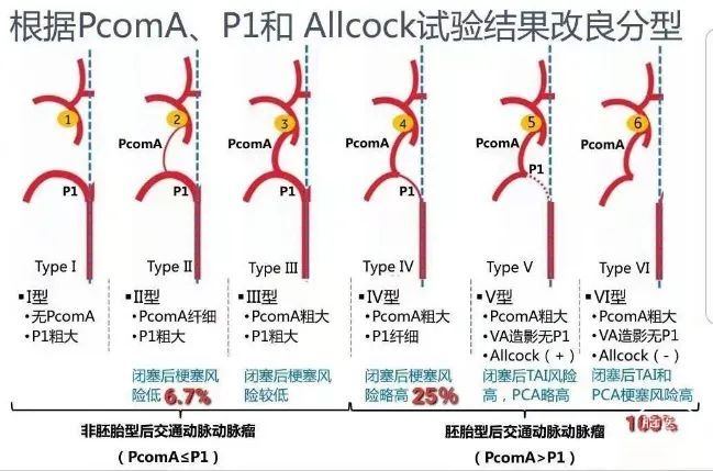 Axium™ Prime在不规则动脉瘤中的应用 - 脑医汇