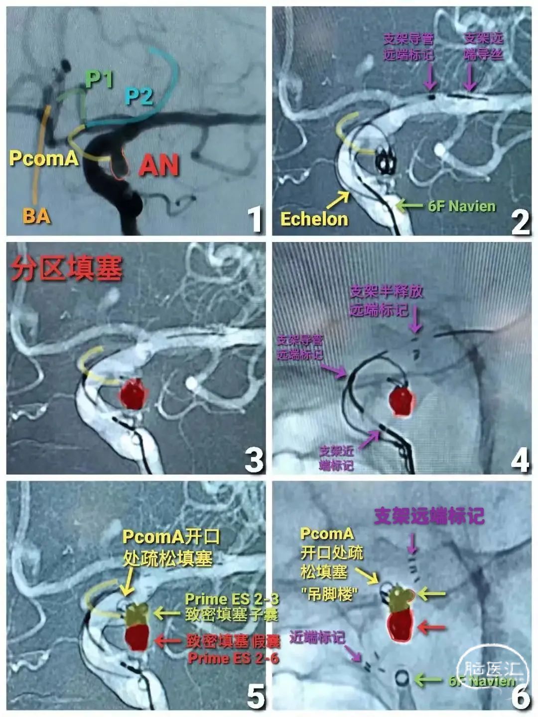 Axium™ Prime在不规则动脉瘤中的应用 - 脑医汇