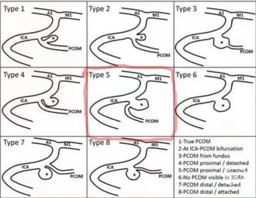 Axium™ Prime在不规则动脉瘤中的应用 - 脑医汇
