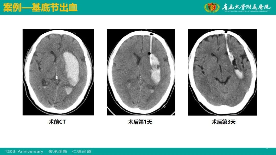 监测有道丨颅内压监测在脑出血外引流手术中的应用——颅脑创伤 神经重症周刊(第255期) 脑医汇