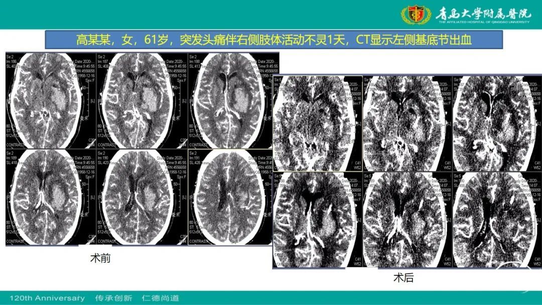 监测有道丨颅内压监测在脑出血外引流手术中的应用——颅脑创伤 神经重症周刊(第255期) 脑医汇