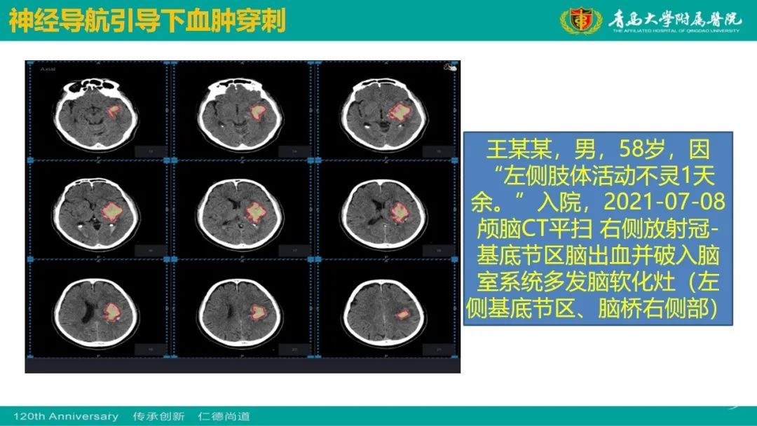 监测有道丨颅内压监测在脑出血外引流手术中的应用——颅脑创伤 神经重症周刊(第255期) 脑医汇