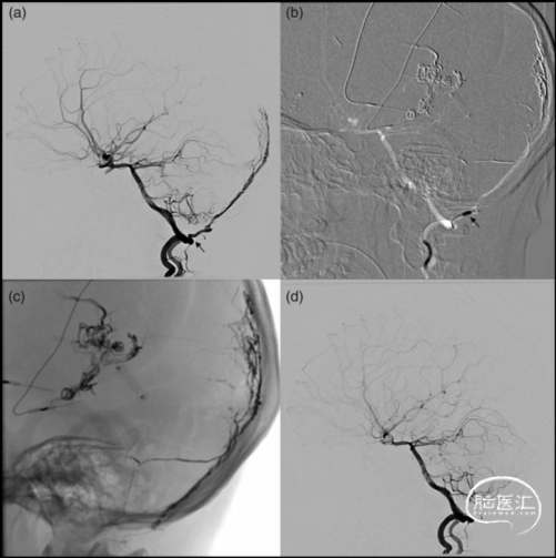 在儿科人群中使用scepter mini球囊导管栓塞血管畸形的初步经验 - 脑医汇