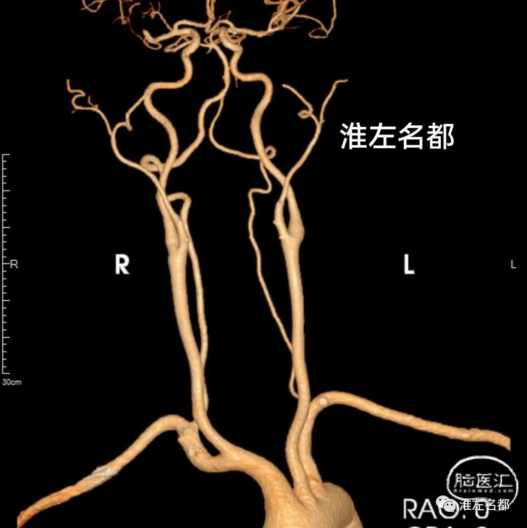 REACT 68剪管技术应用于取栓后MCA M2狭窄血管成形术 - 脑医汇