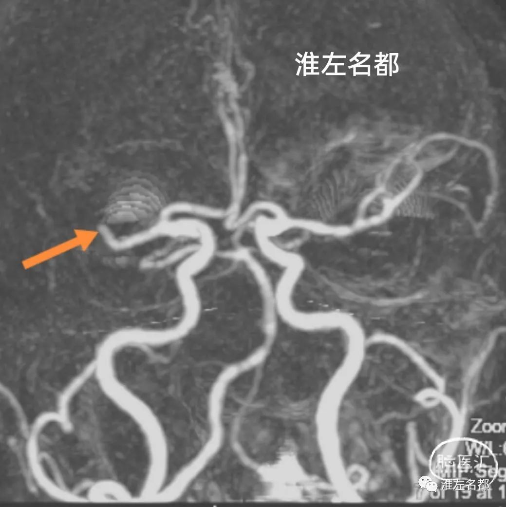 REACT 68剪管技术应用于取栓后MCA M2狭窄血管成形术 - 脑医汇