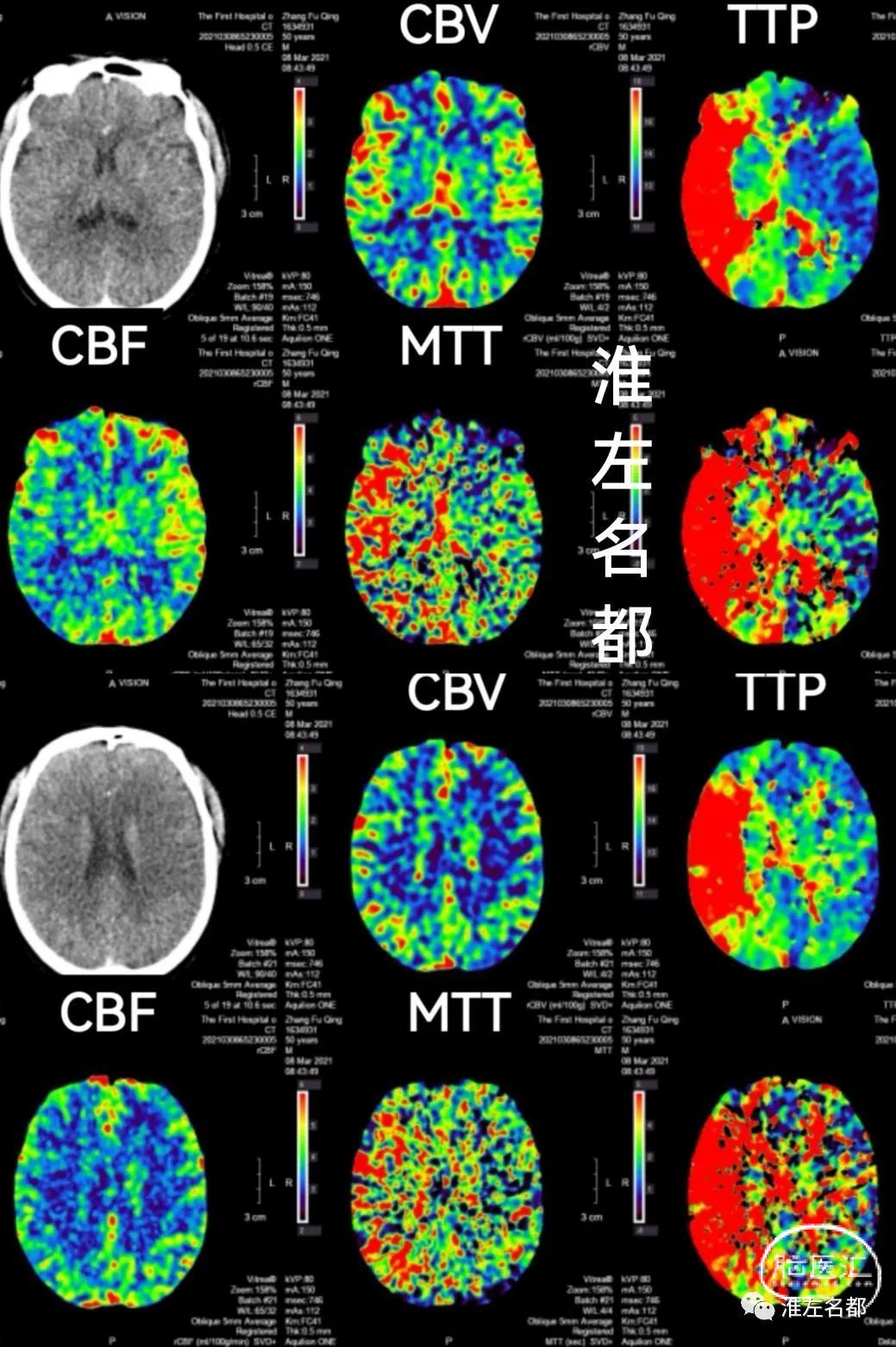 REACT 68剪管技术应用于取栓后MCA M2狭窄血管成形术 - 脑医汇