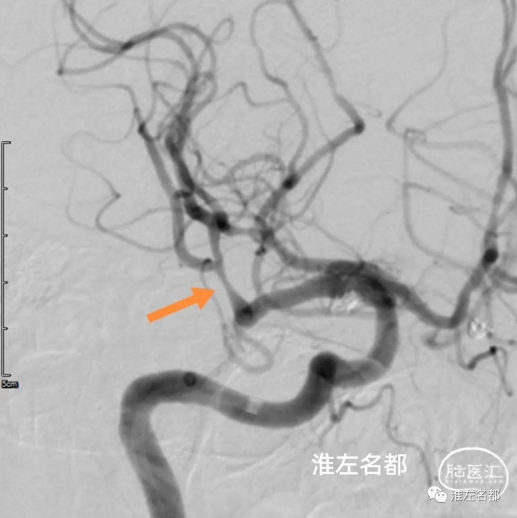 REACT 68剪管技术应用于取栓后MCA M2狭窄血管成形术 - 脑医汇