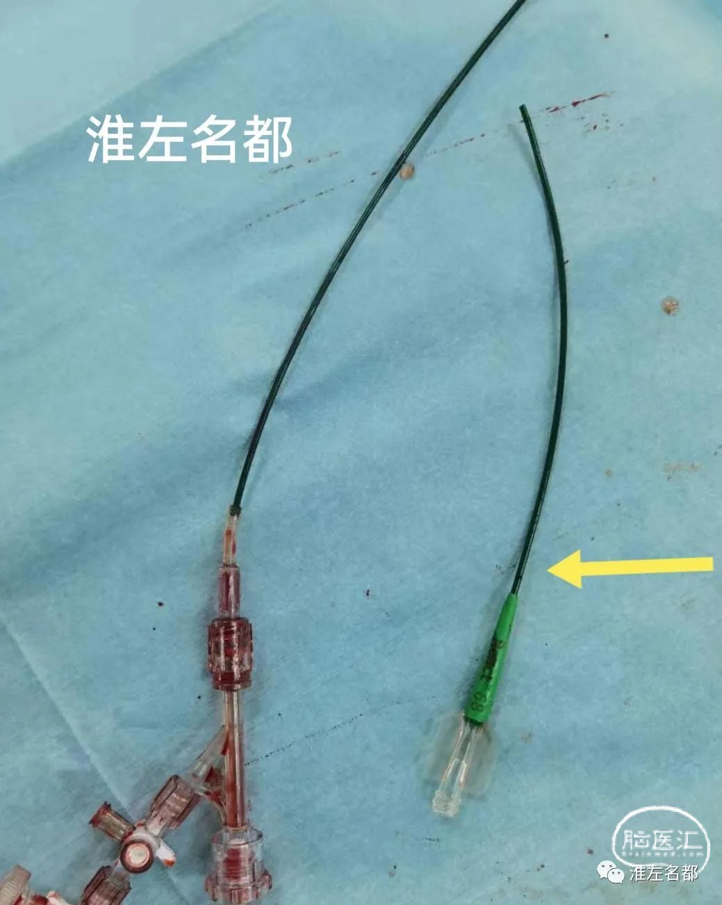 REACT 68剪管技术应用于取栓后MCA M2狭窄血管成形术 - 脑医汇