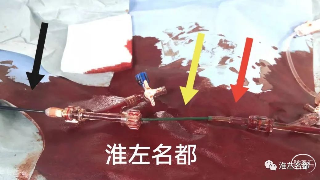 REACT 68剪管技术应用于取栓后MCA M2狭窄血管成形术 - 脑医汇