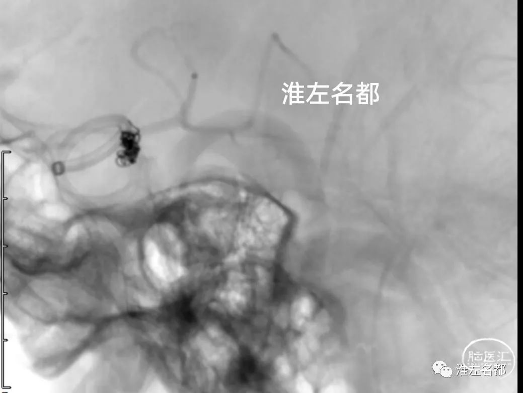 REACT 68剪管技术应用于取栓后MCA M2狭窄血管成形术 - 脑医汇