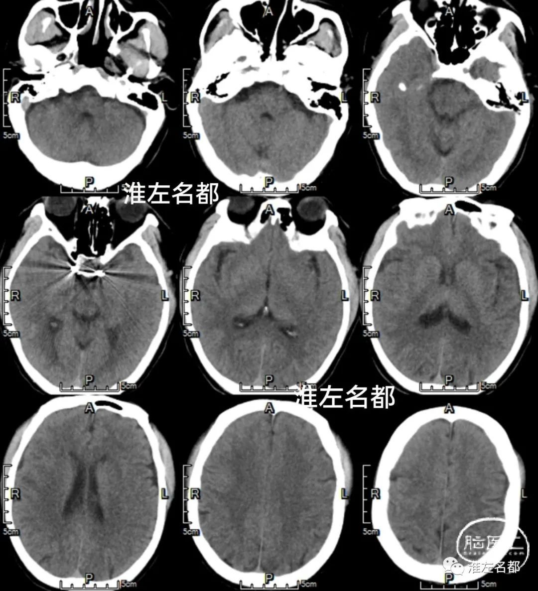 REACT 68剪管技术应用于取栓后MCA M2狭窄血管成形术 - 脑医汇