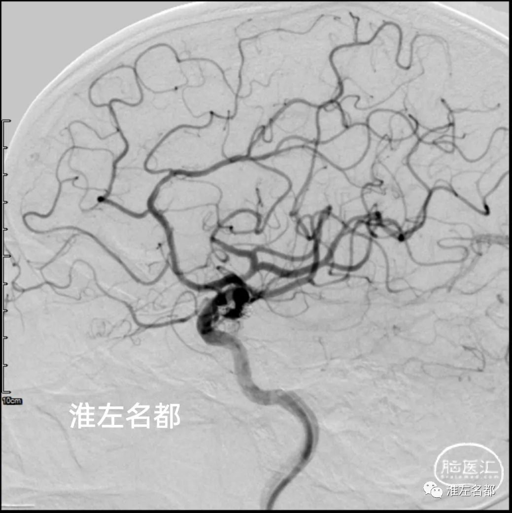 REACT 68剪管技术应用于取栓后MCA M2狭窄血管成形术 - 脑医汇