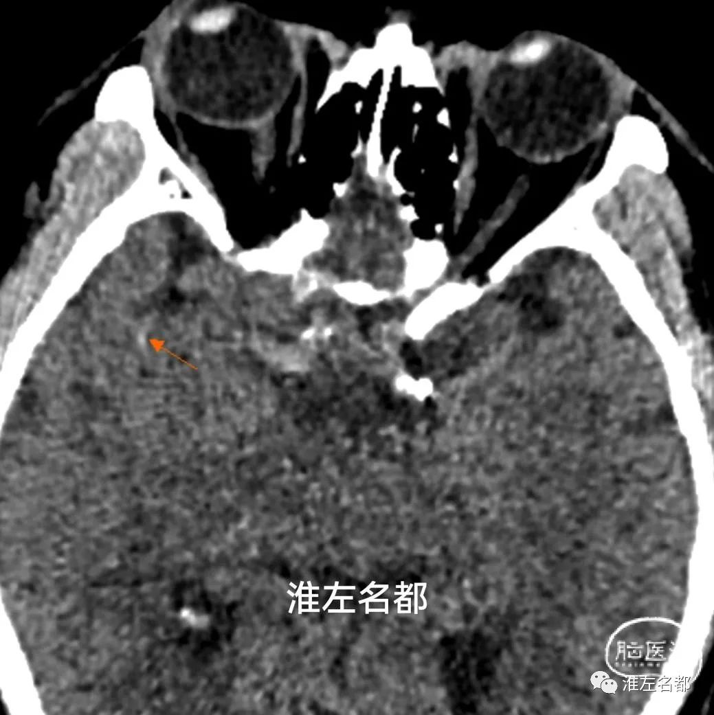 REACT 68剪管技术应用于取栓后MCA M2狭窄血管成形术 - 脑医汇