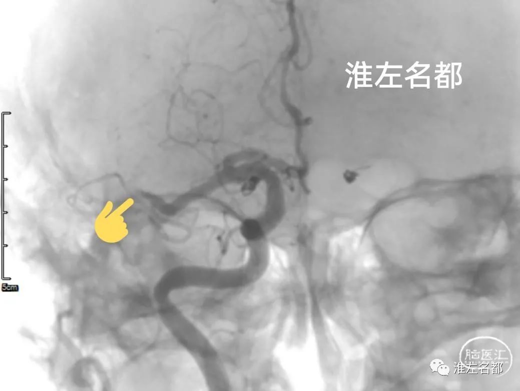 REACT 68剪管技术应用于取栓后MCA M2狭窄血管成形术 - 脑医汇