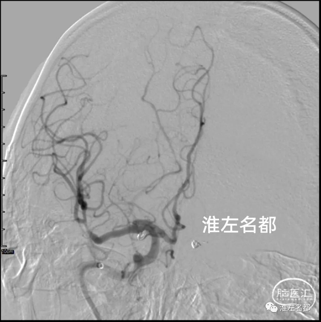 REACT 68剪管技术应用于取栓后MCA M2狭窄血管成形术 - 脑医汇
