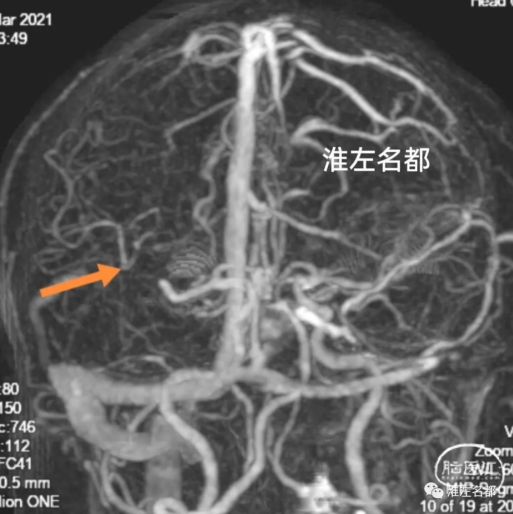 REACT 68剪管技术应用于取栓后MCA M2狭窄血管成形术 - 脑医汇