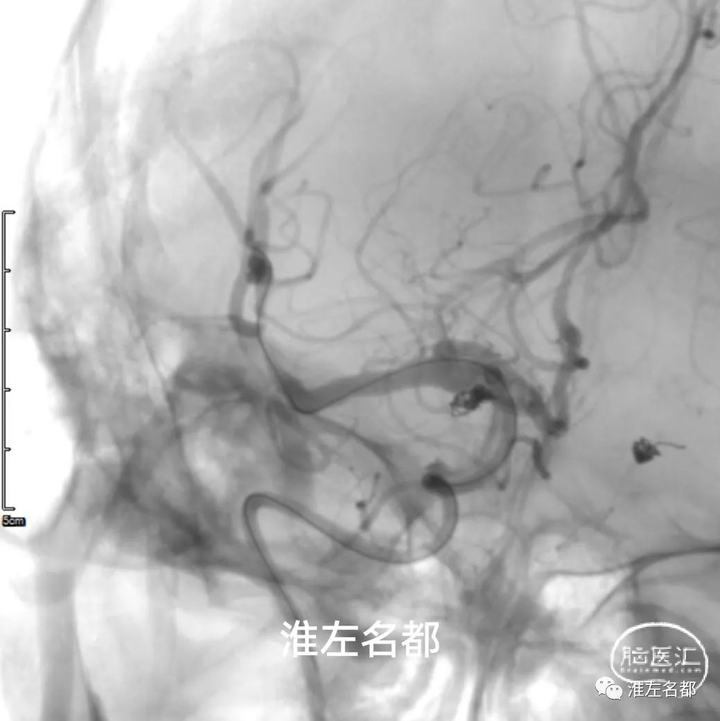 REACT 68剪管技术应用于取栓后MCA M2狭窄血管成形术 - 脑医汇