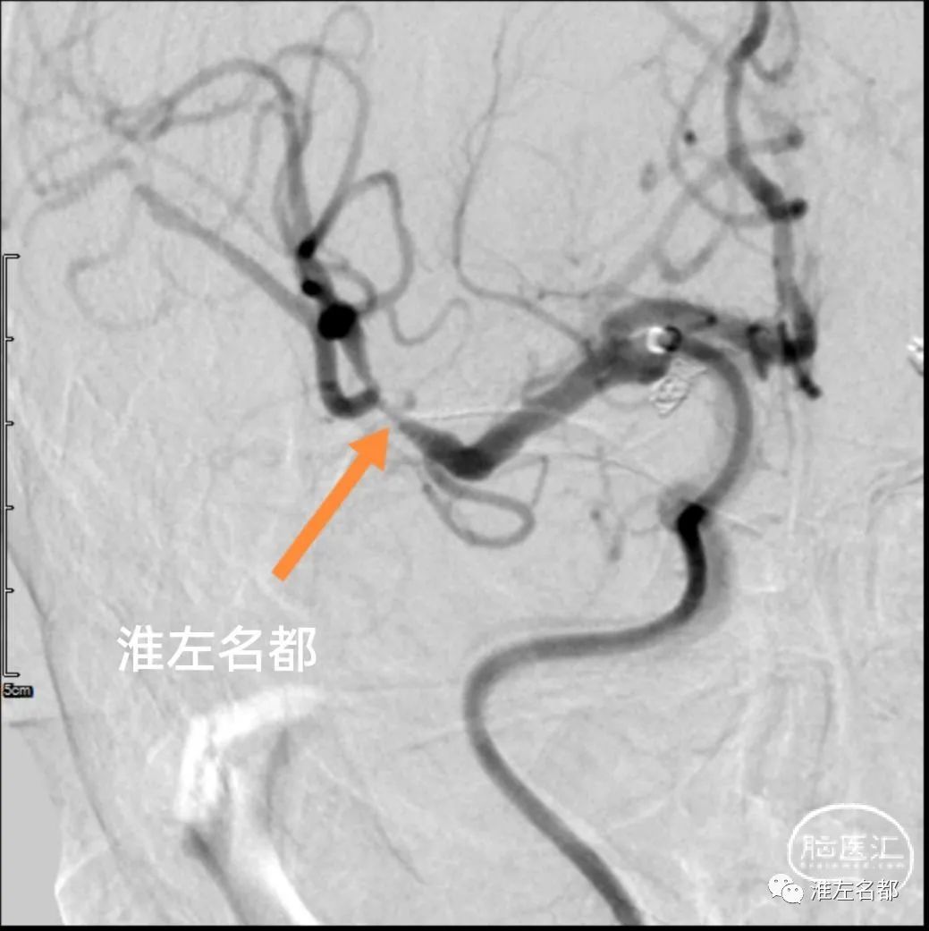 REACT 68剪管技术应用于取栓后MCA M2狭窄血管成形术 - 脑医汇