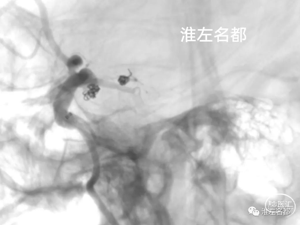 REACT 68剪管技术应用于取栓后MCA M2狭窄血管成形术 - 脑医汇