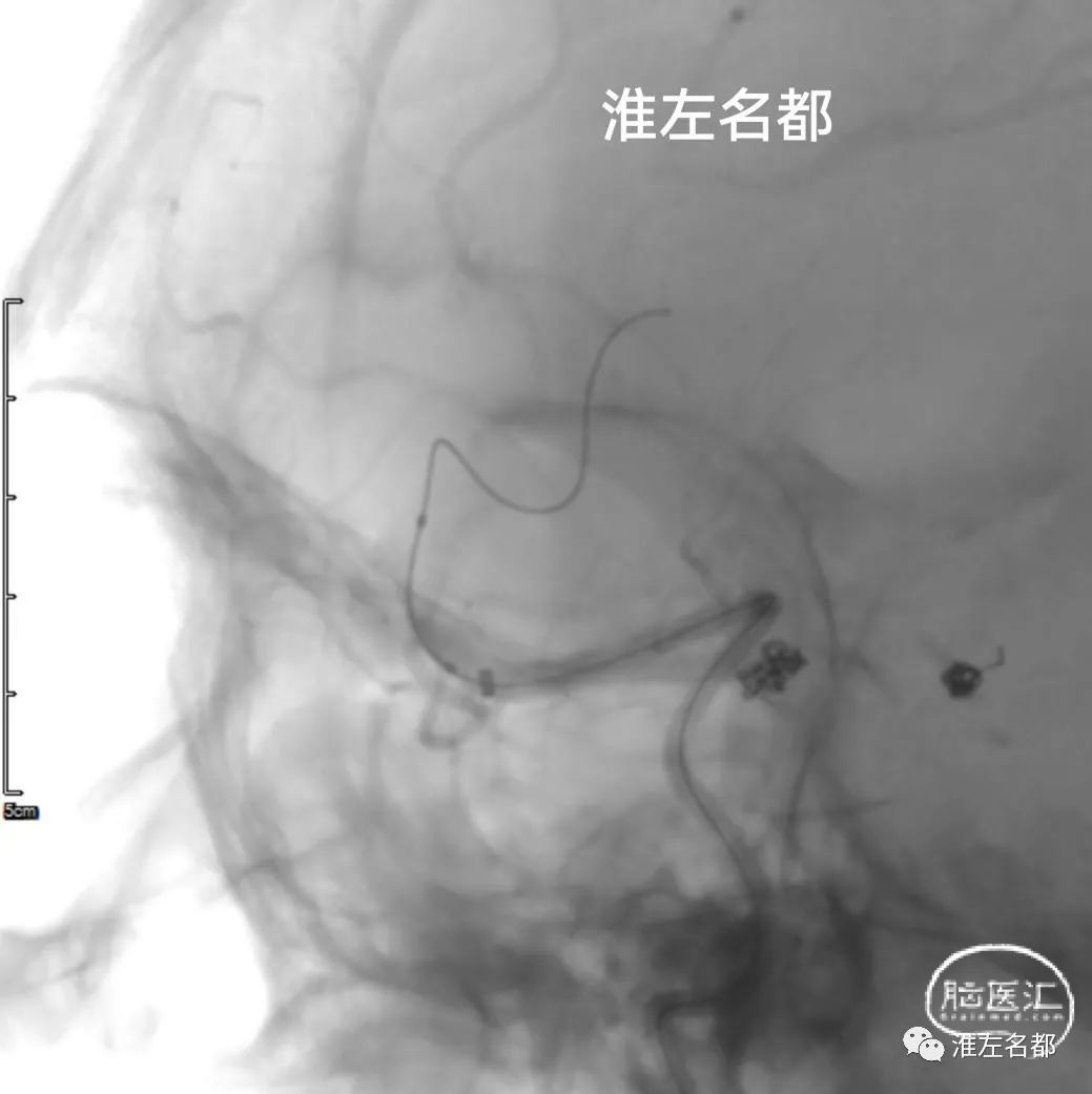 REACT 68剪管技术应用于取栓后MCA M2狭窄血管成形术 - 脑医汇
