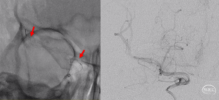 全程显影｜Syphonet®取栓支架治疗大脑中动脉M1急性闭塞一例 - 脑医汇 - 神外资讯 - 神介资讯