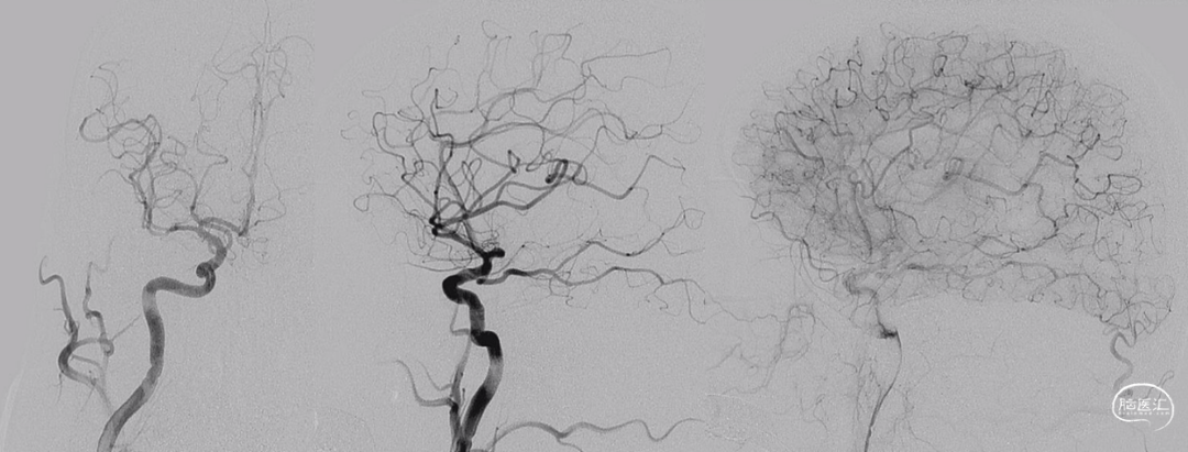 全程显影｜Syphonet®取栓支架治疗大脑中动脉M1急性闭塞一例 - 脑医汇
