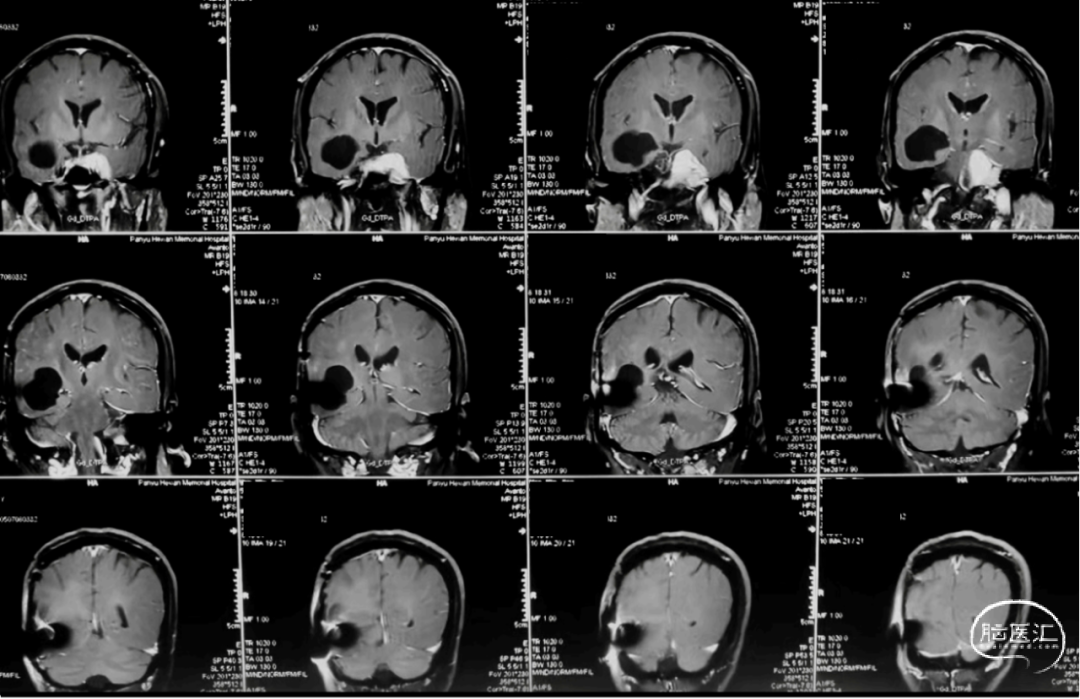 一例胶质母细胞瘤（WHO IV级）IDH野生型患者，通过标准Stupp方案联合肿瘤电场治疗，生存获益明显 - 脑医汇
