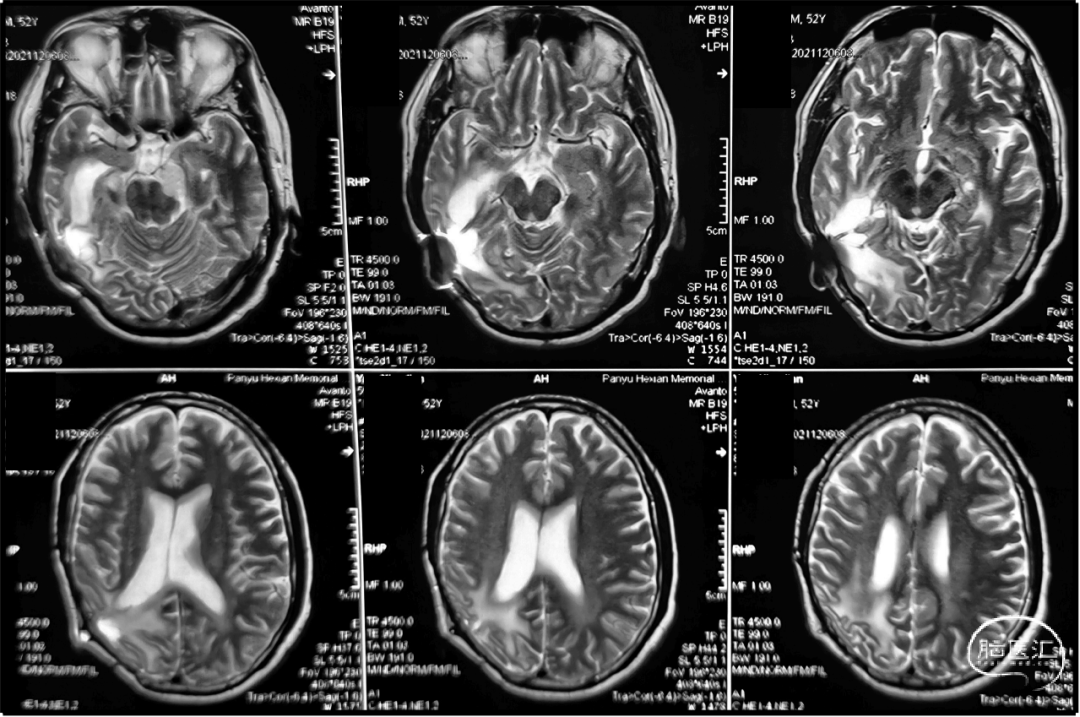 一例胶质母细胞瘤（WHO IV级）IDH野生型患者，通过标准Stupp方案联合肿瘤电场治疗，生存获益明显 - 脑医汇