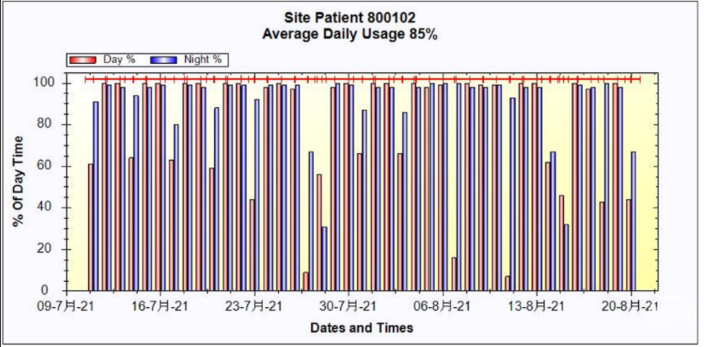 一例胶质母细胞瘤（WHO IV级）IDH野生型患者，通过标准Stupp方案联合肿瘤电场治疗，生存获益明显 - 脑医汇