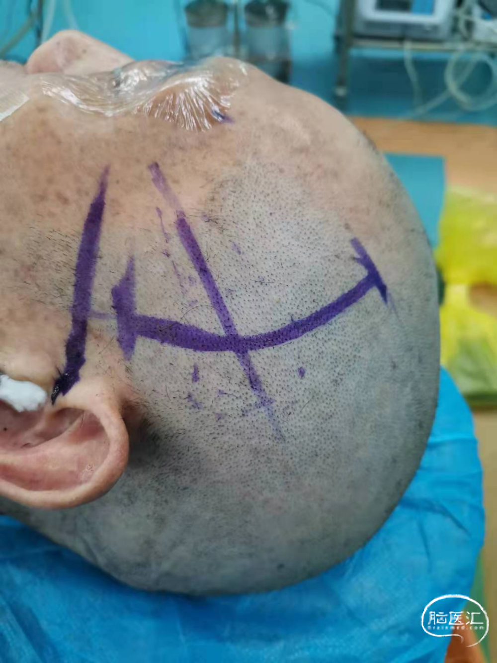 小骨窗经侧裂岛叶皮质造瘘血肿清除术 左基底节脑出血 脑医汇