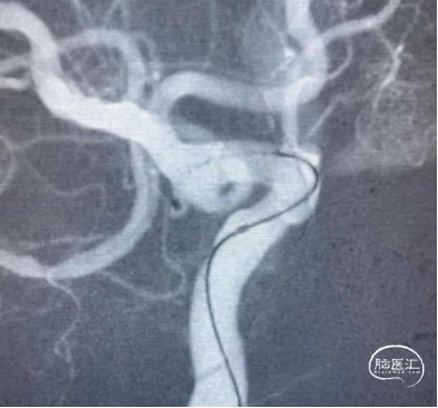 Axium™ Prime单纯栓塞治疗微小动脉瘤 - 脑医汇 - 神外资讯 - 神介资讯