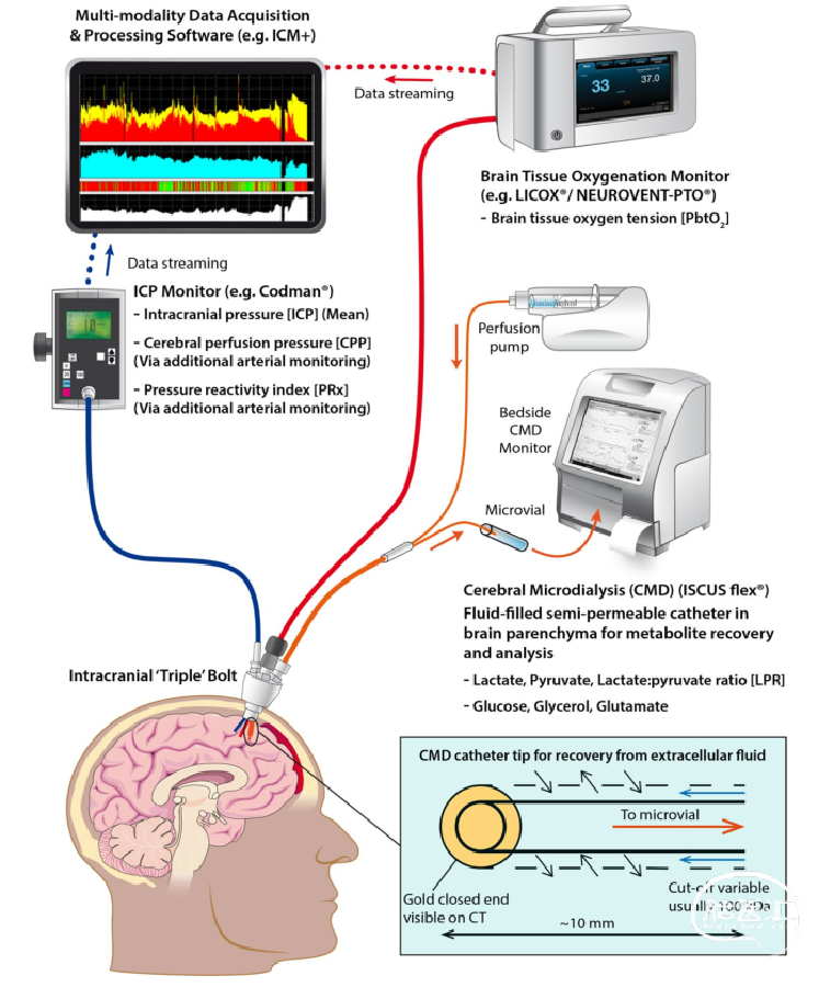 监测有道丨颅内压监护下重型颅脑损伤的综合救治——颅脑创伤-神经重症周刊（第265期） - 脑医汇 - 神外资讯 - 神介资讯