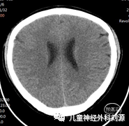 Muenke综合征颅缝早闭的影像特点 - 脑医汇