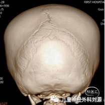 Muenke综合征颅缝早闭的影像特点 - 脑医汇