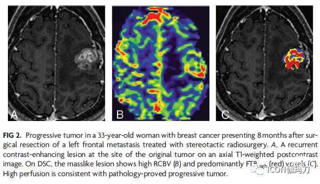【文献摘要】从DSC灌注MRI获得的肿瘤负荷分数和相对CBV鉴别放射外科治疗转移瘤的肿瘤进展与放射性坏死 - 脑医汇